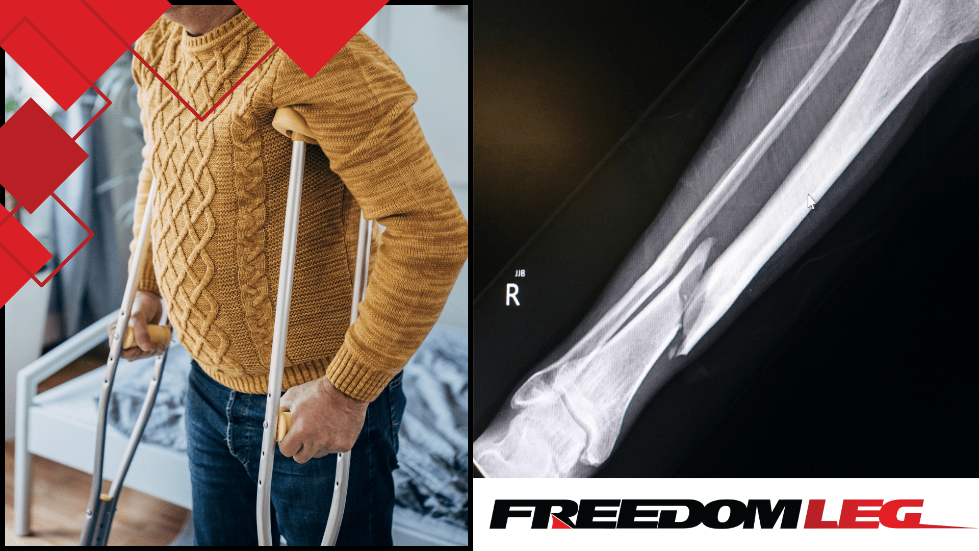 Tibia Fracture Treatment and Recovery Guide – Freedom Leg brace
